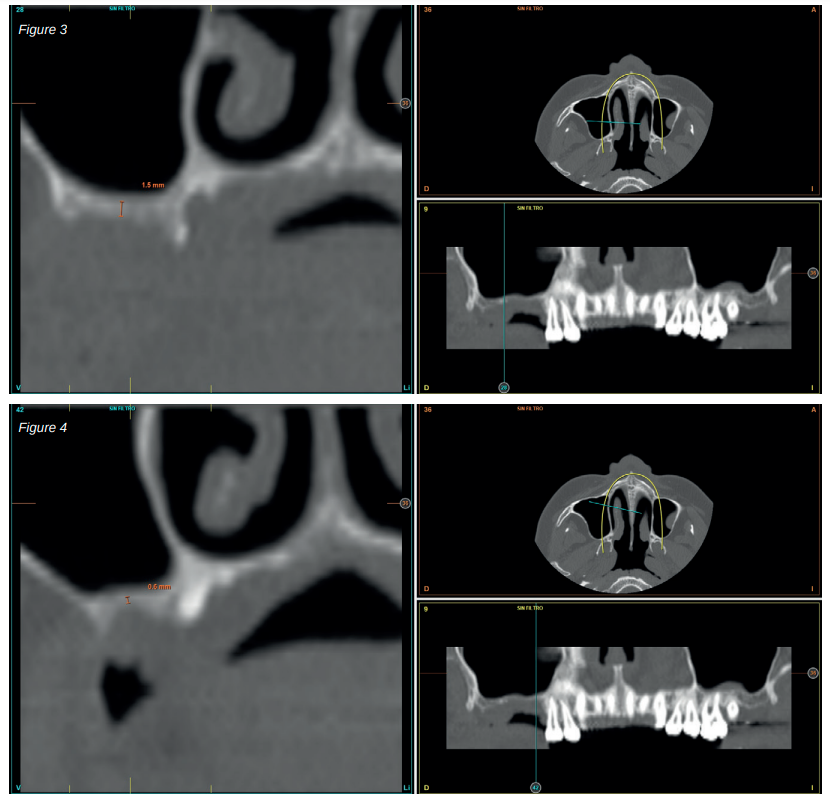 Atrophic posterior maxilla: sinus elevation with lateral approach Vs ...