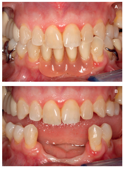 Extreme vertical and horizontal atrophy combined in posterior ...