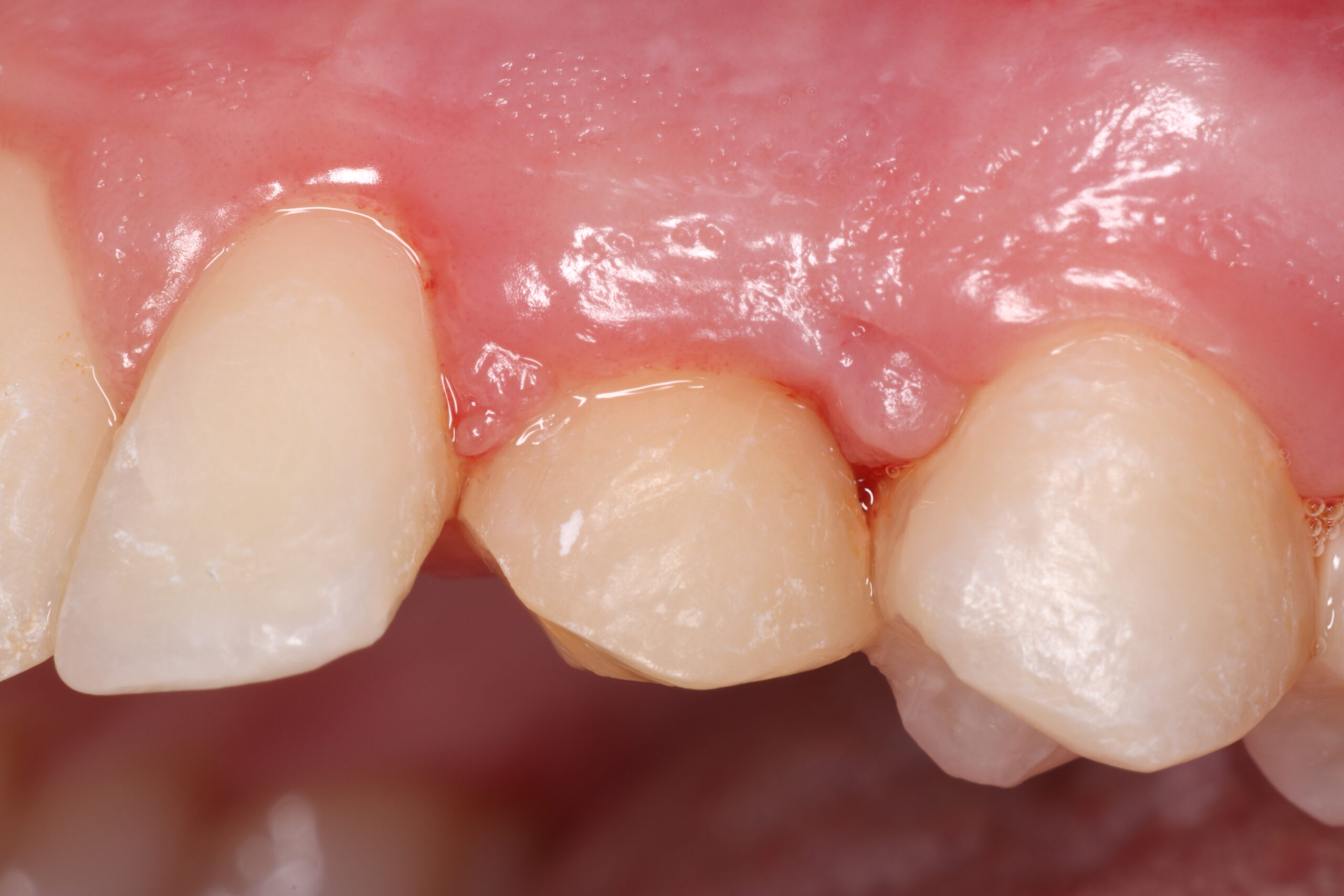 Integral surgical and orthodontic treatment of an autotransplanted ...